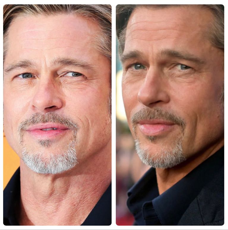 The Rise and Rise of Lip Fillers for Men | Glowday