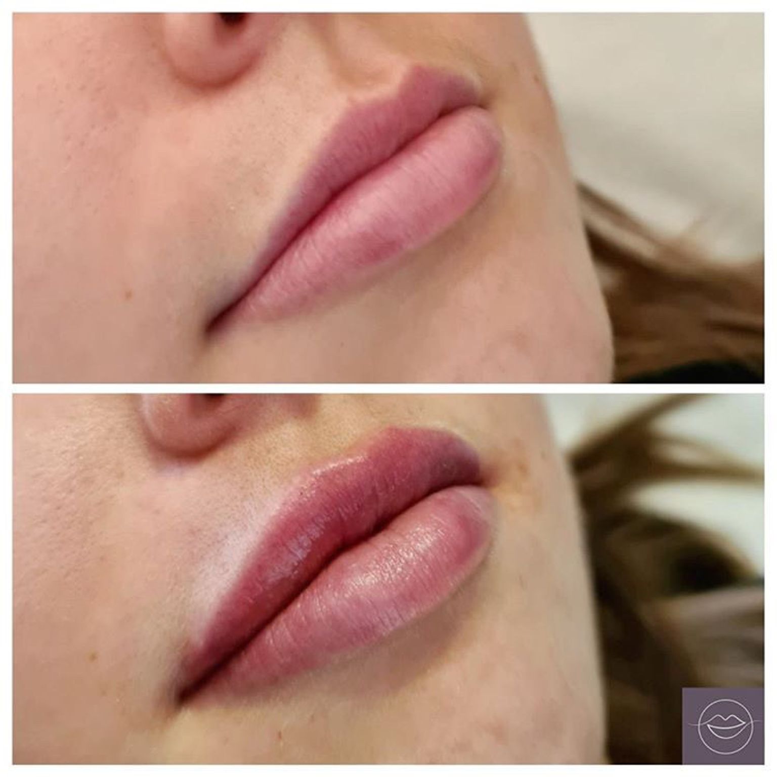 Top 10 Lip Fillers in London | Glowday