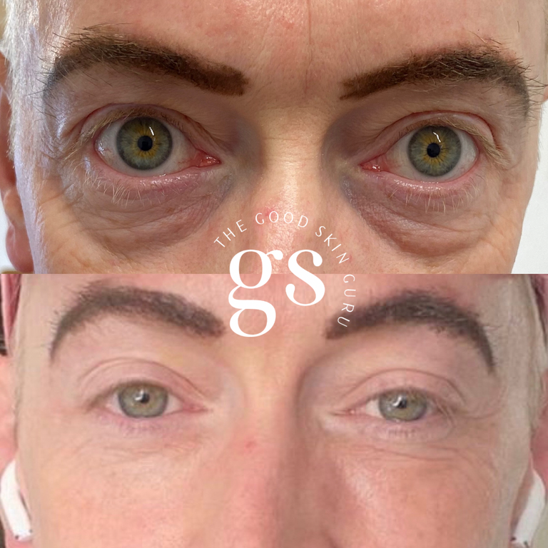 What is Mesotherapy? | Glowday