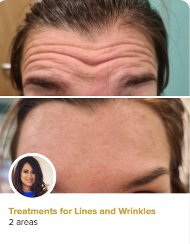 Botox Areas: Where Can You Get Botox? | Glowday