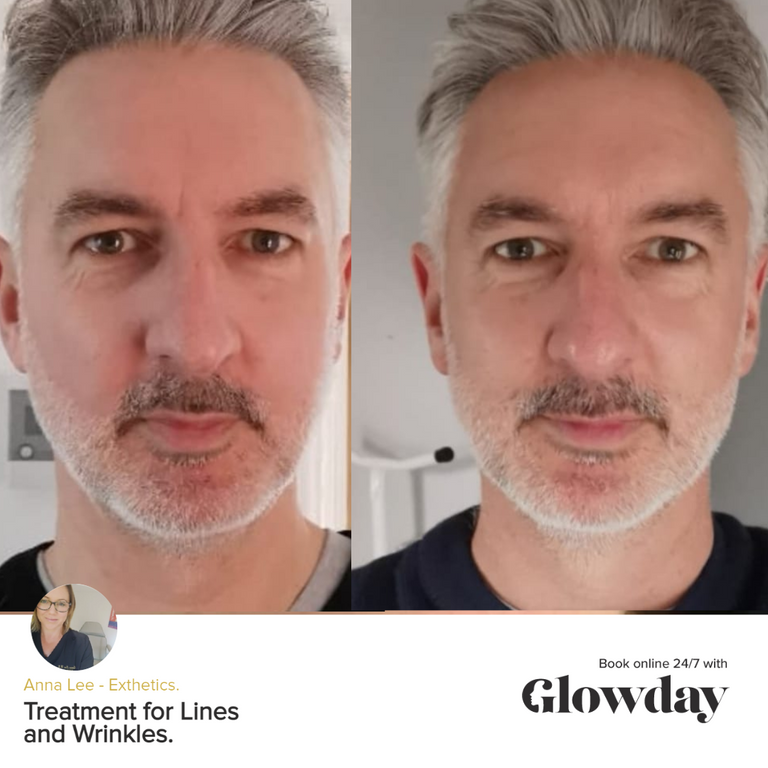 Botox for men, why I think it's great! | Glowday