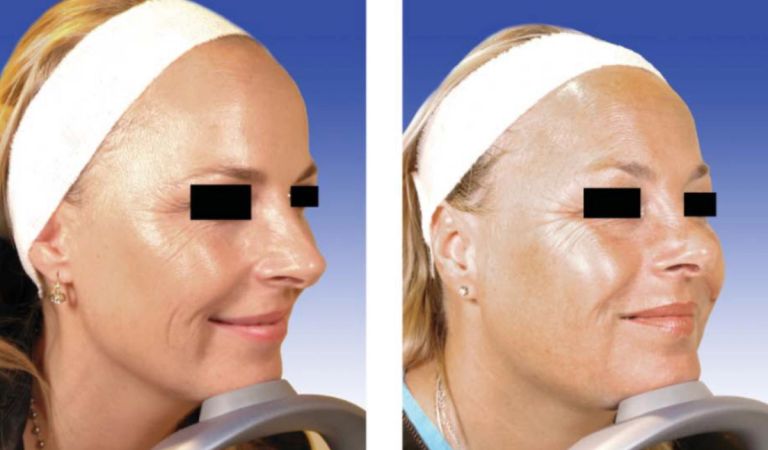 Twins Study Reveals the Power of Botox for Youthful Skin | Glowday