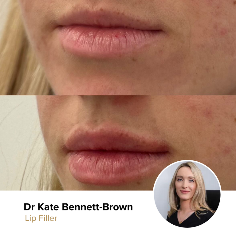 Top 10 Lip Fillers in London | Glowday