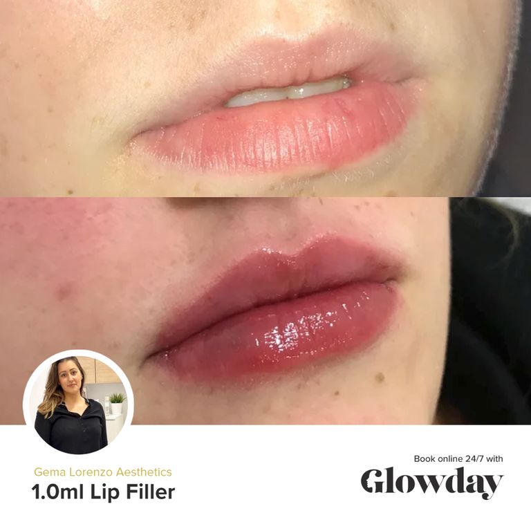 Love Island, Lip Fillers and Botox | Glowday