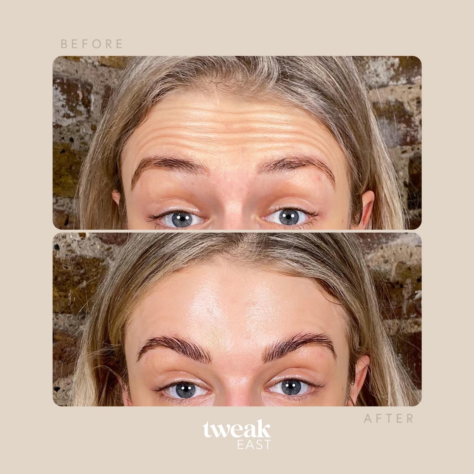 The Shame Of Botox Was Stopping Me Being Happy | Glowday