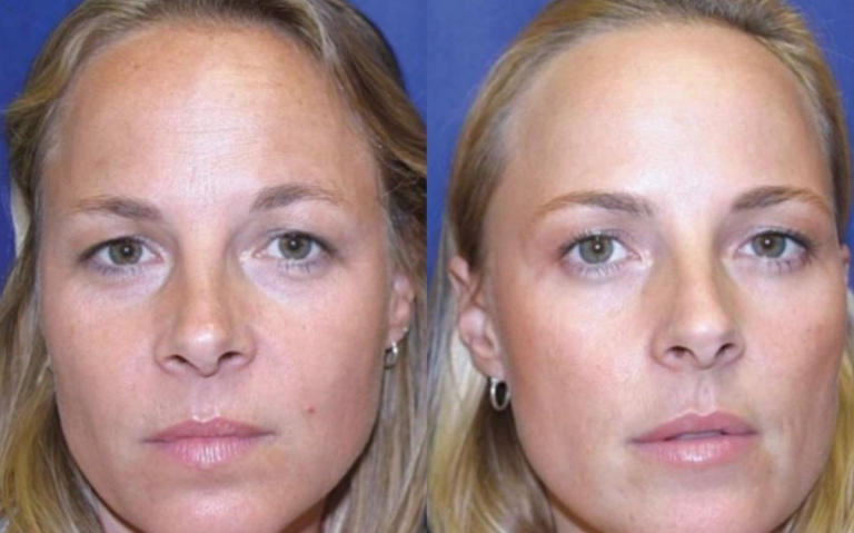 Twins Study Reveals the Power of Botox for Youthful Skin | Glowday