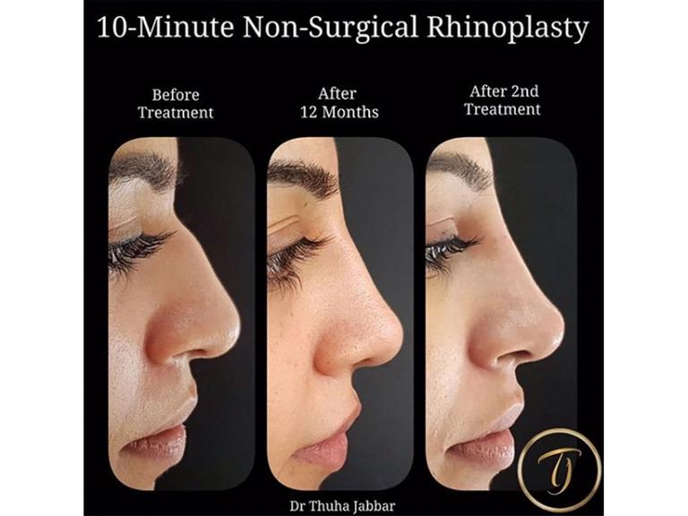 The Non-Surgical Nose Job Explained | Glowday