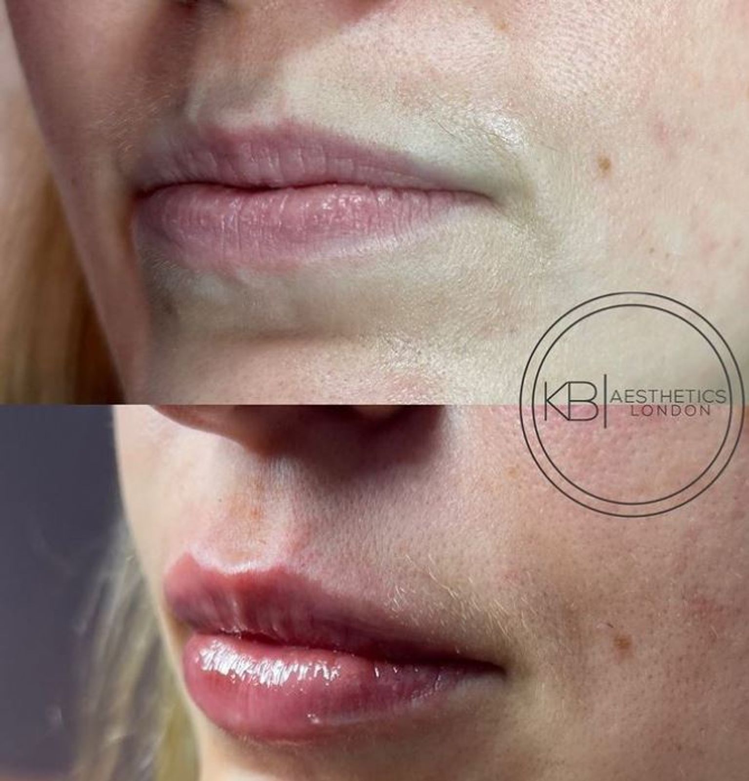 What Does 1ml Of Lip Filler Look Like Glowday What Does 1ml Of Lip Filler Look Like Glowday