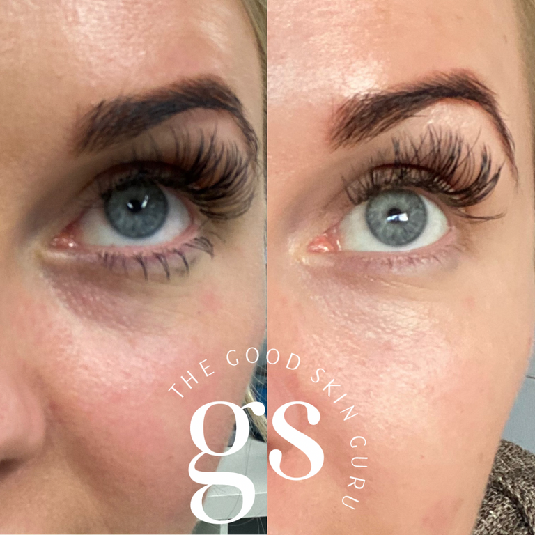 What is Mesotherapy? | Glowday