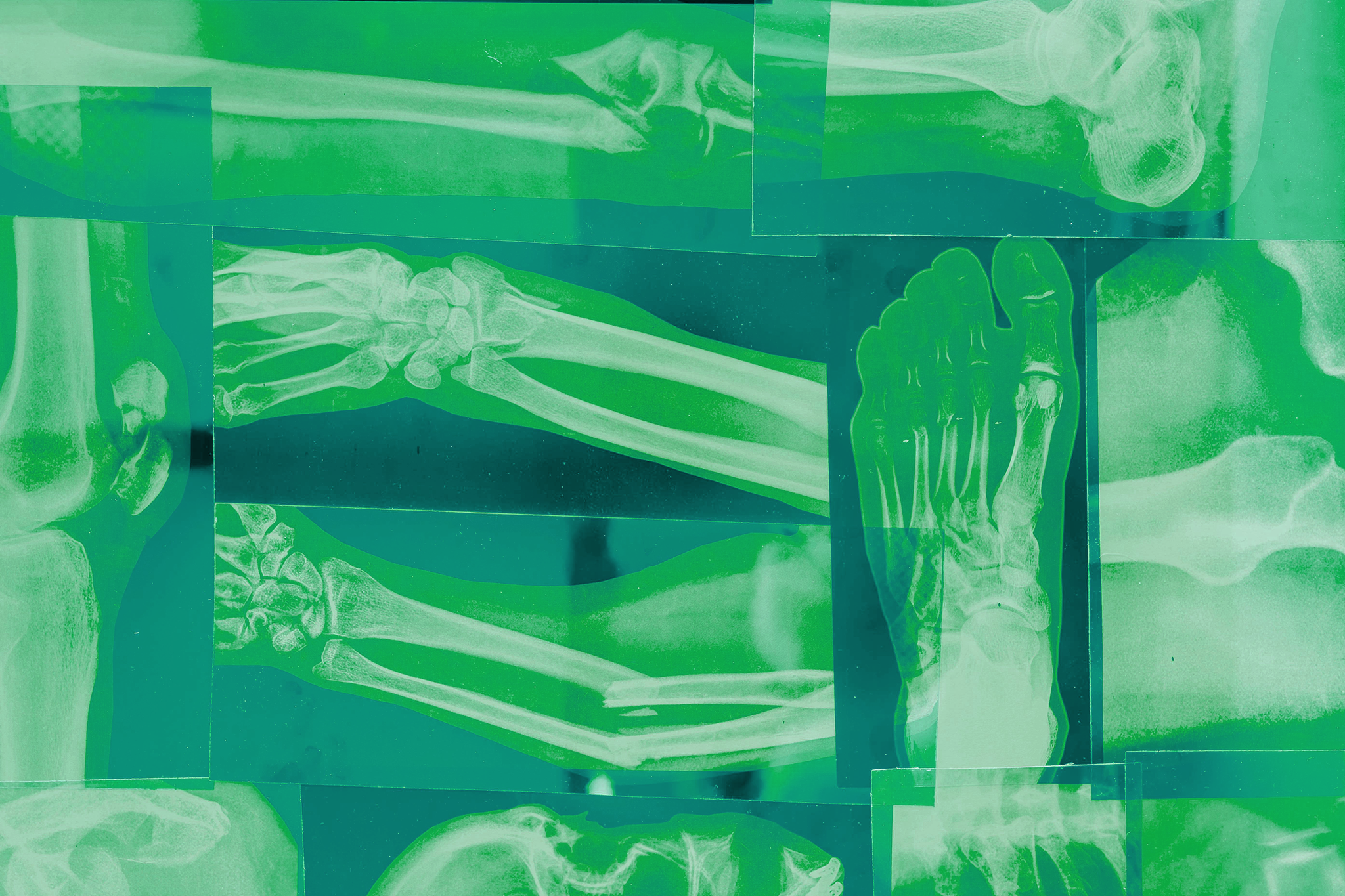 Darauf solltest du achten, wenn du deine Knochen stärken willst | AG1