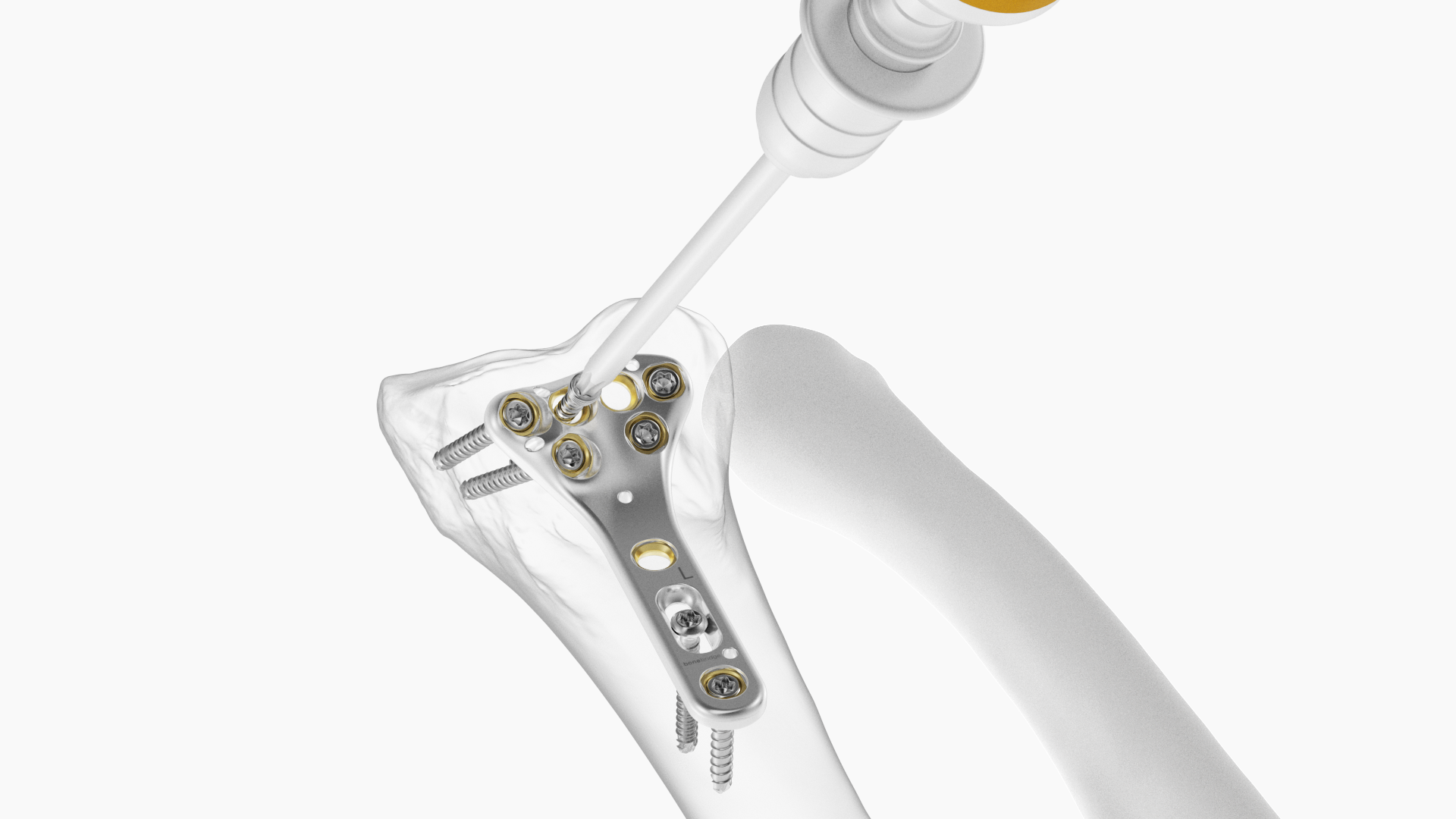 Bonebridge - SALGINA