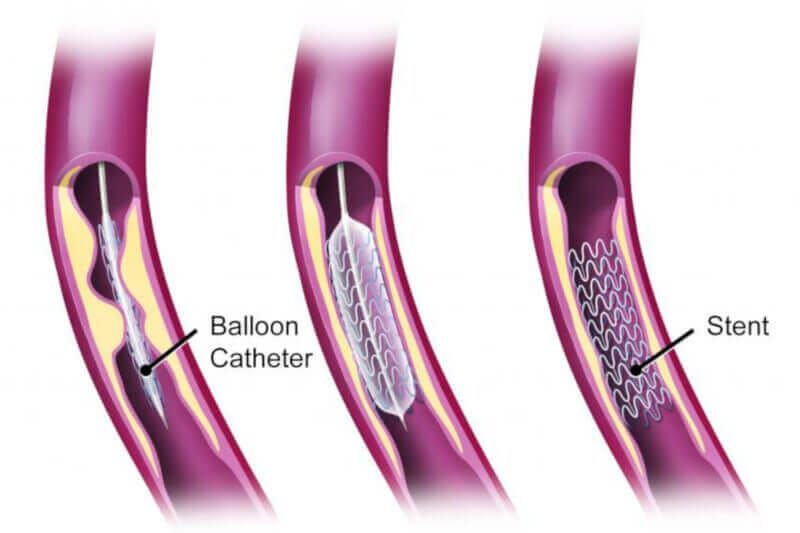 Exercise Guidelines After Angioplasty & Stent | 2025 Update