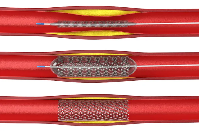 Exercise Guidelines After Angioplasty & Stent | 2025 Update