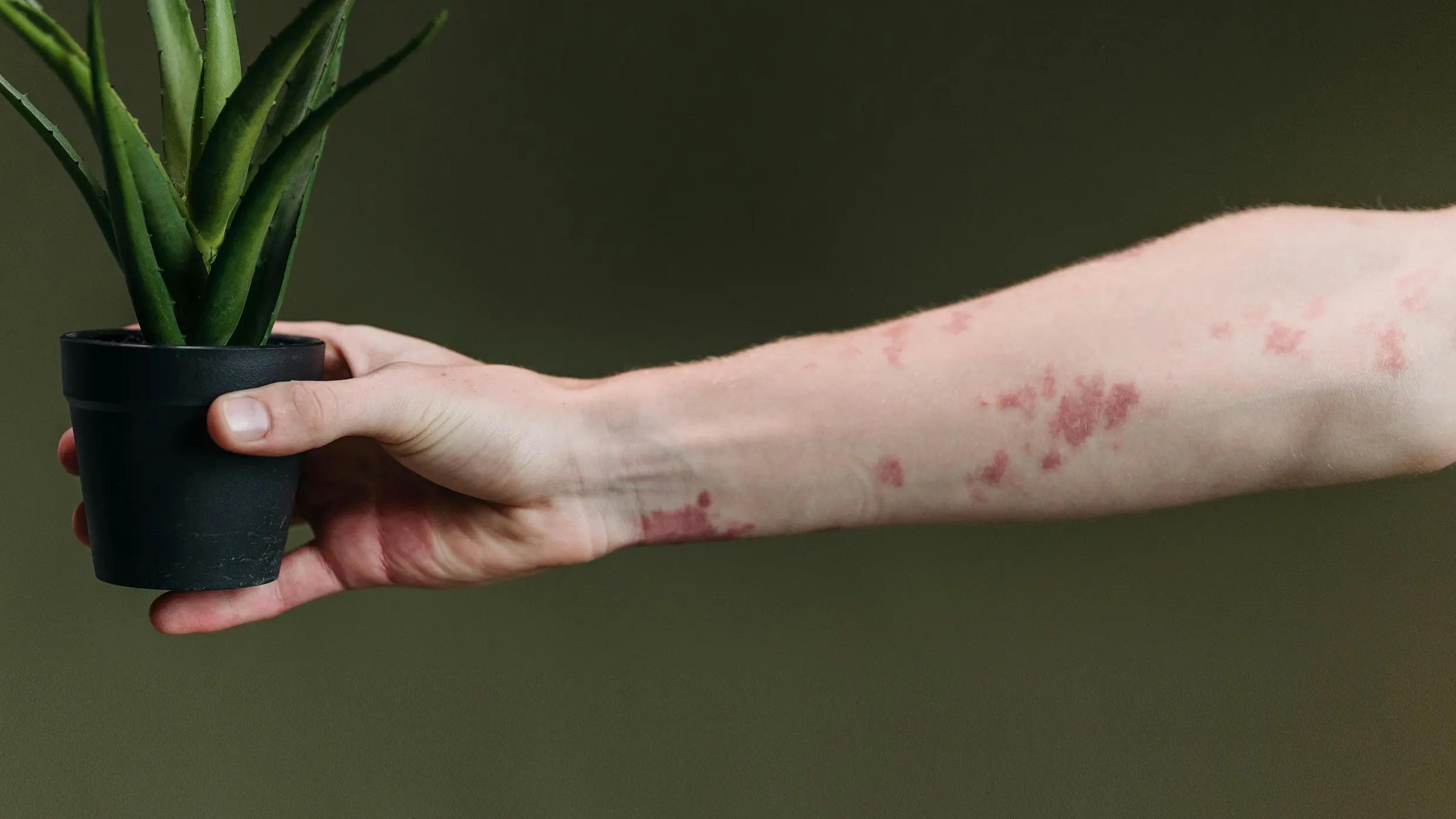 Autoimmune Disorders Sometimes Affect the Skin