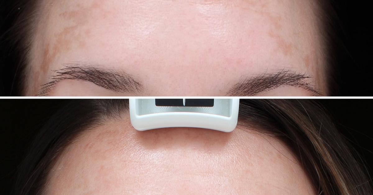 Behandling av Melasma | Eraze