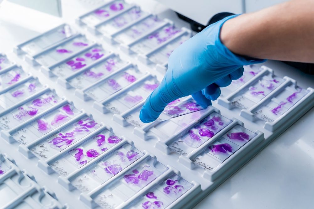 Types of Prostate Cancer: A Tissue-Level Overview