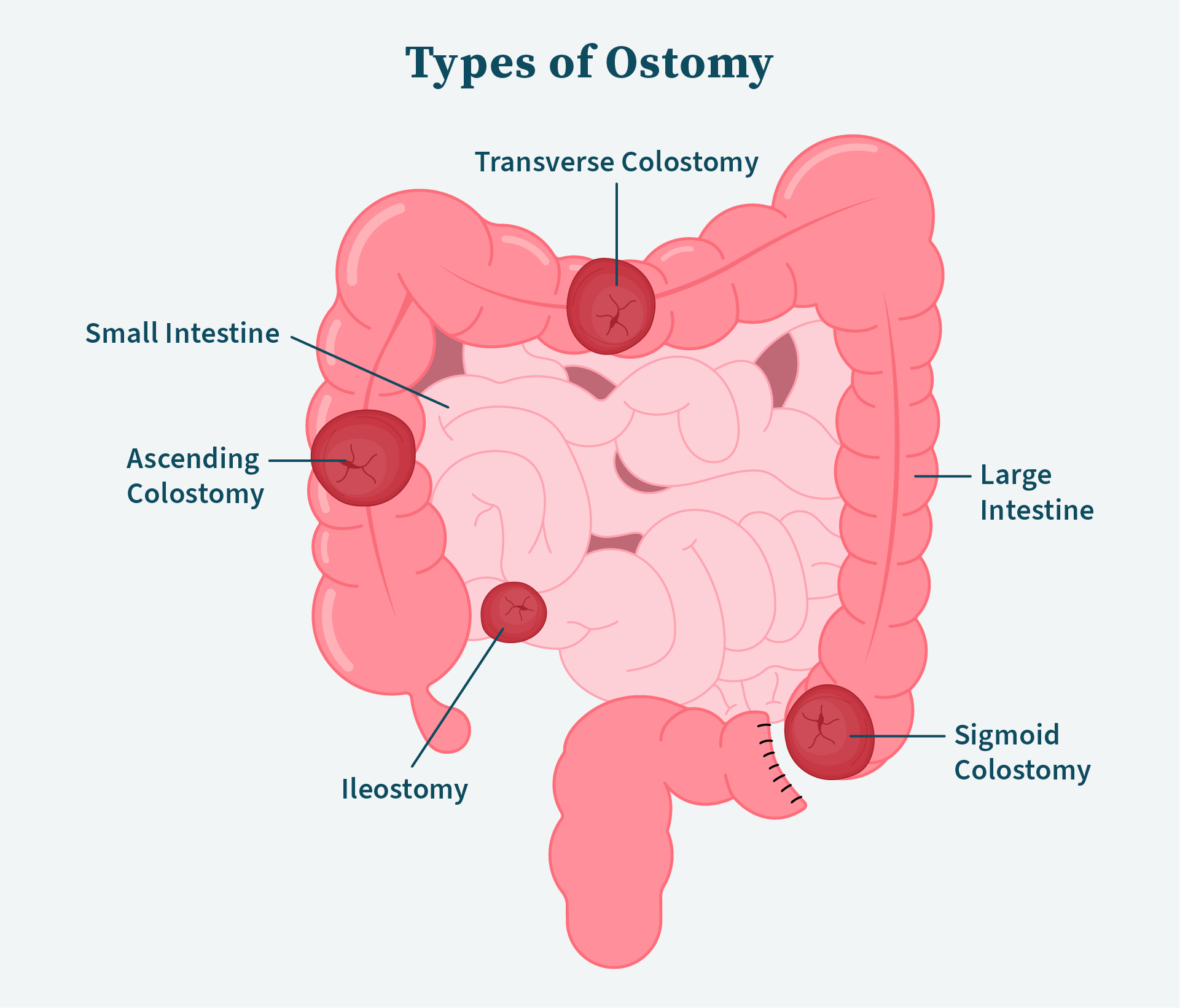 sigmoid colostomy