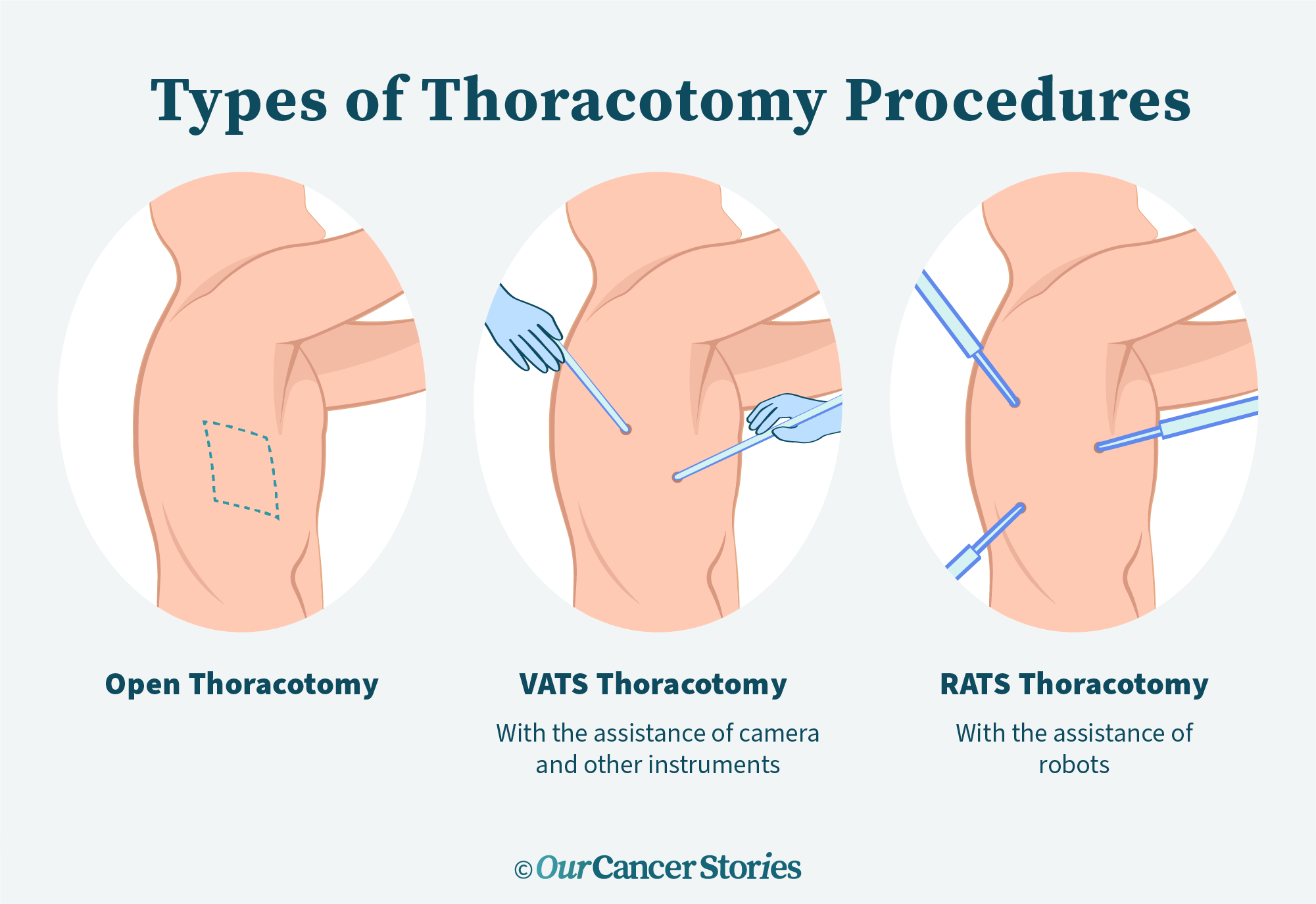surgery for lung cancer name