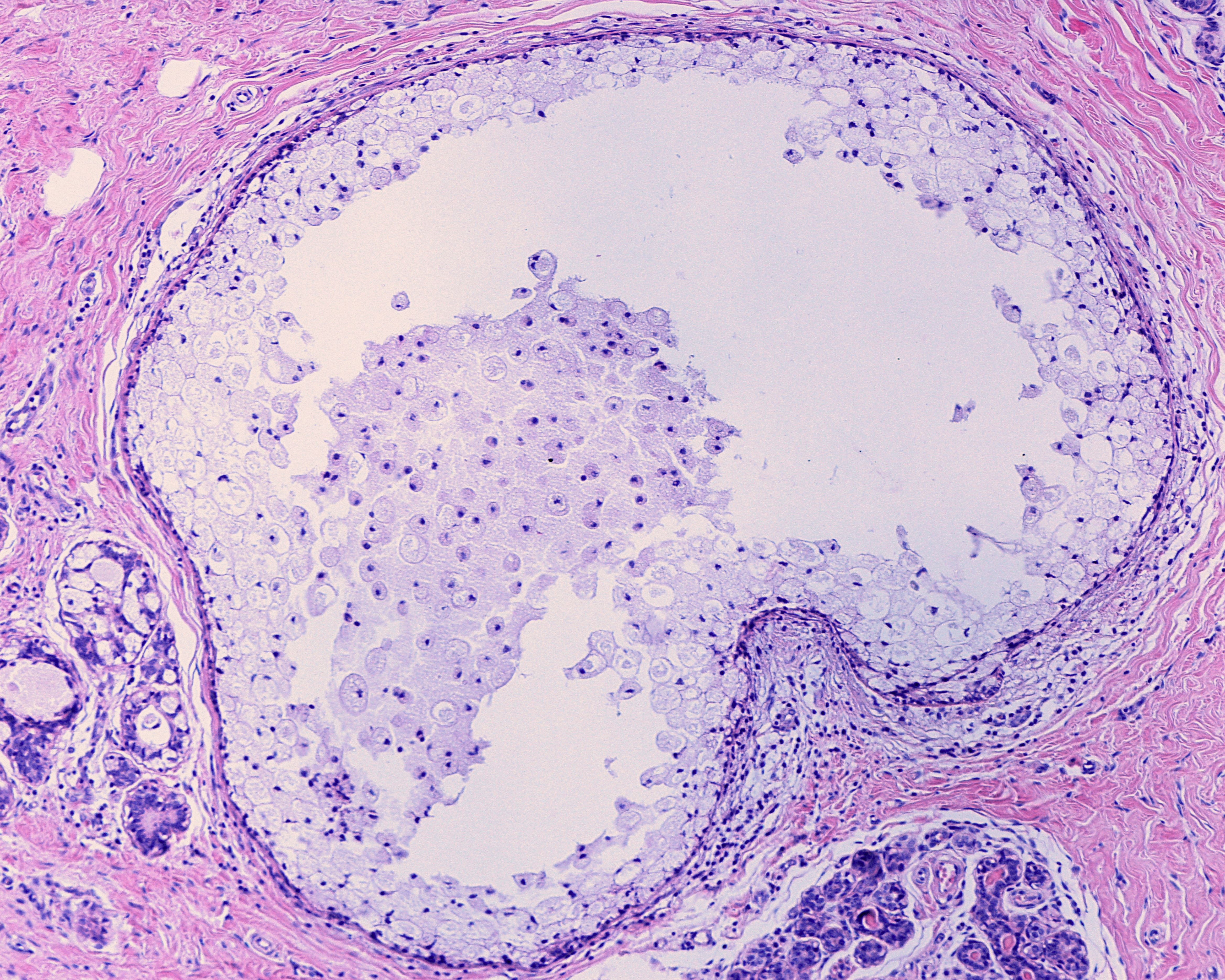 Duct Ectasia: Can It Lead to Breast Cancer?