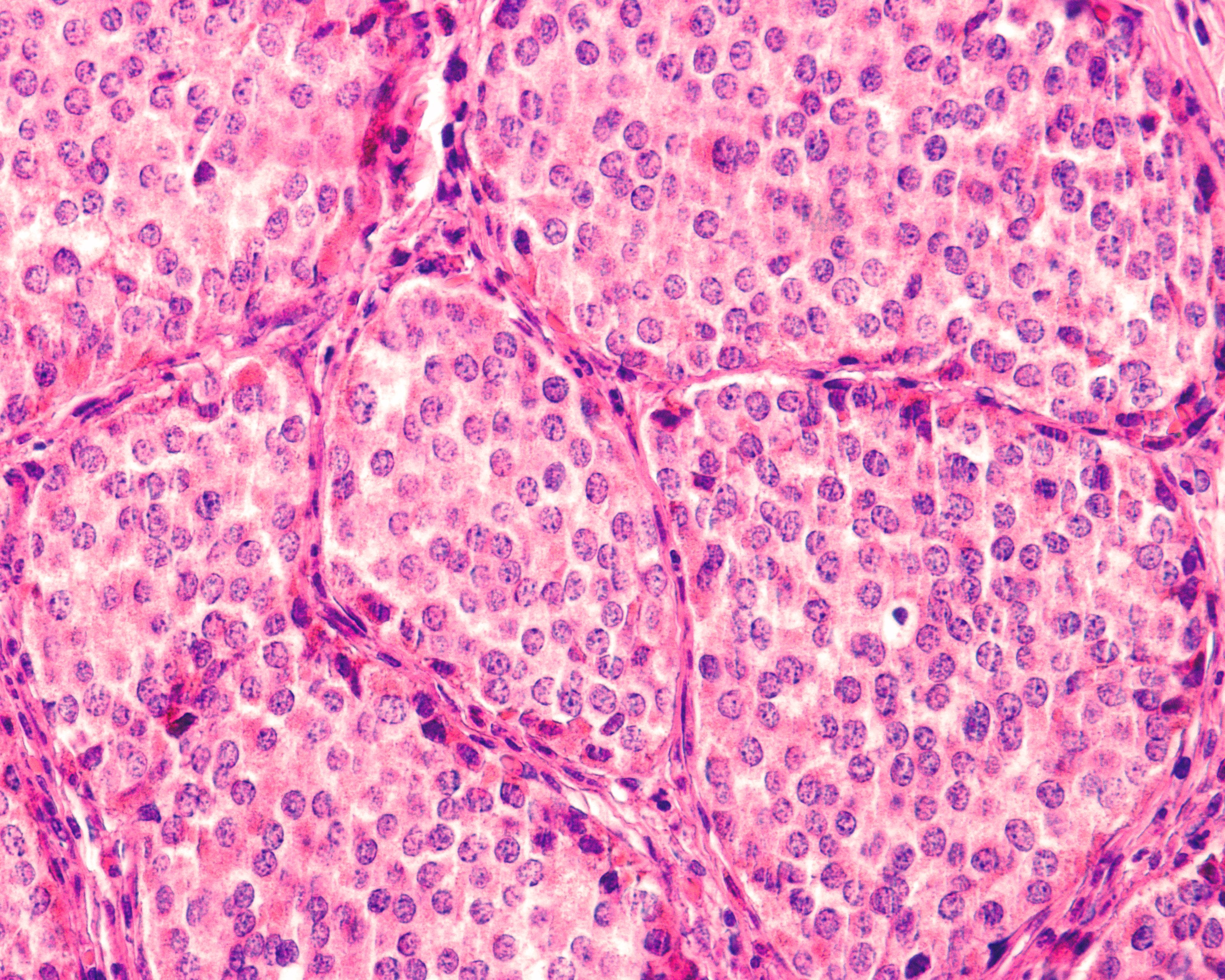 Gastric Neuroendocrine Tumors (NETs)