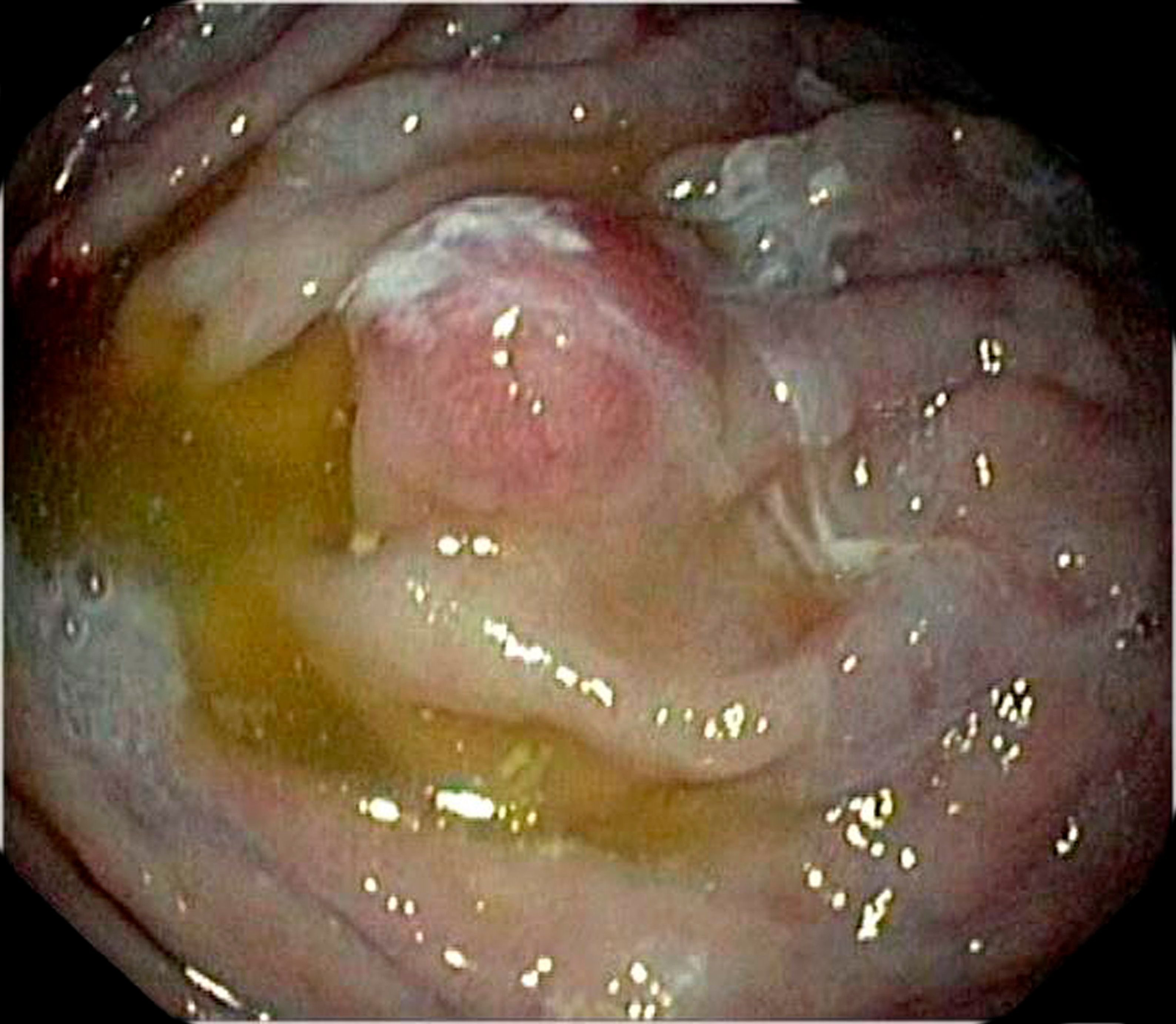 Gastric Neuroendocrine Tumors (NETs)