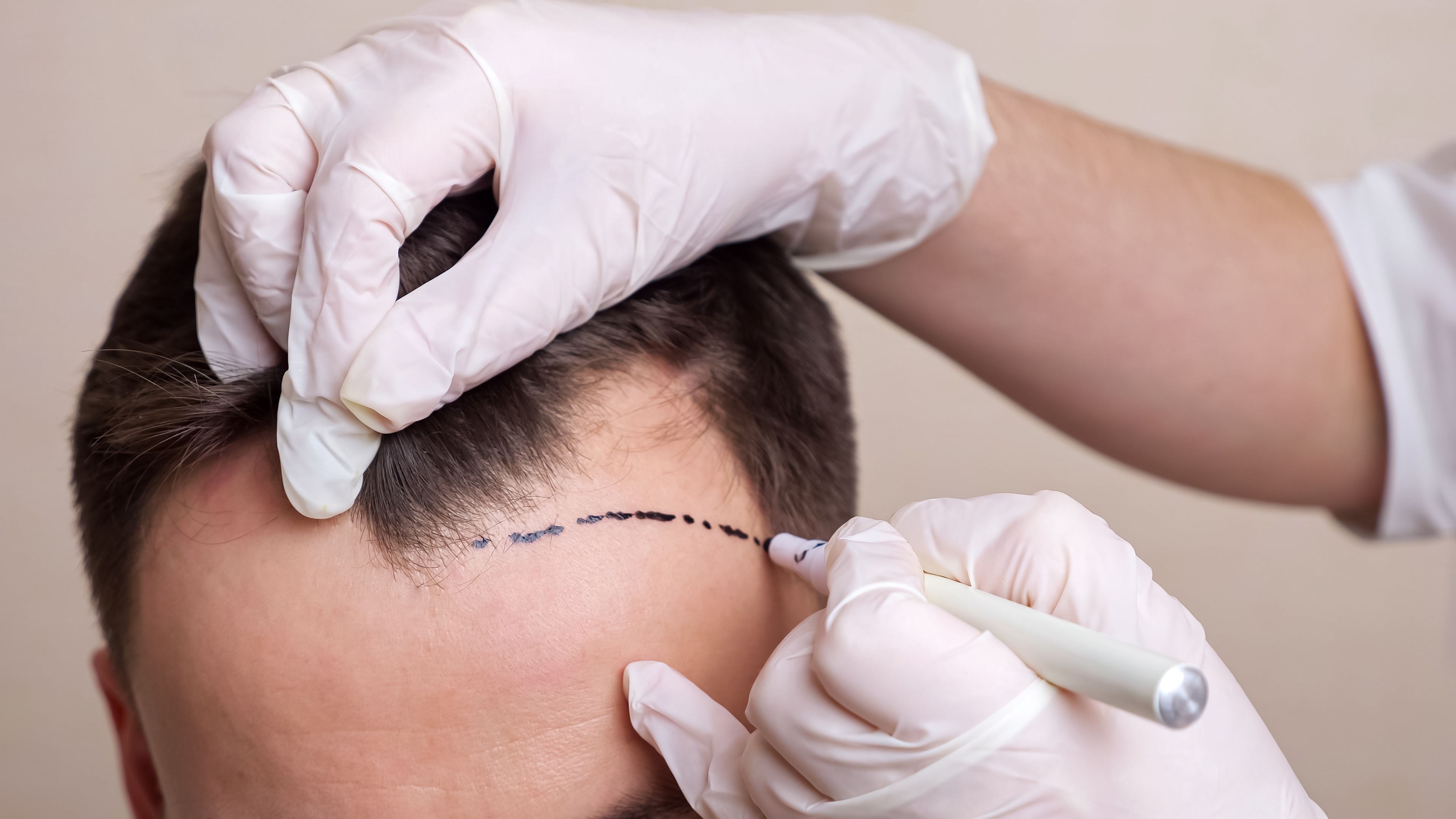 Finasteride and Prostate Cancer