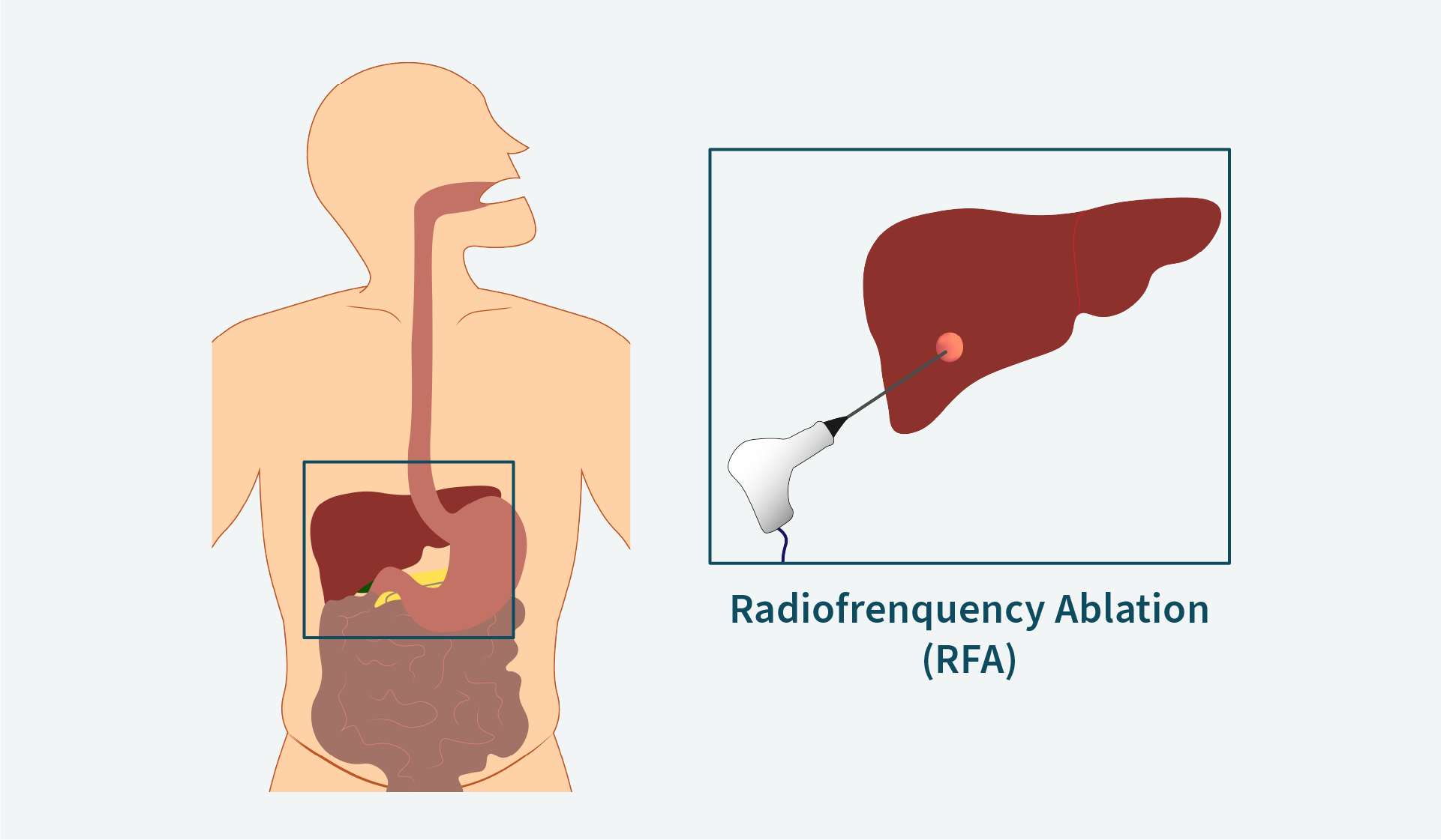 Ablation for GISTs and Gastric NETs