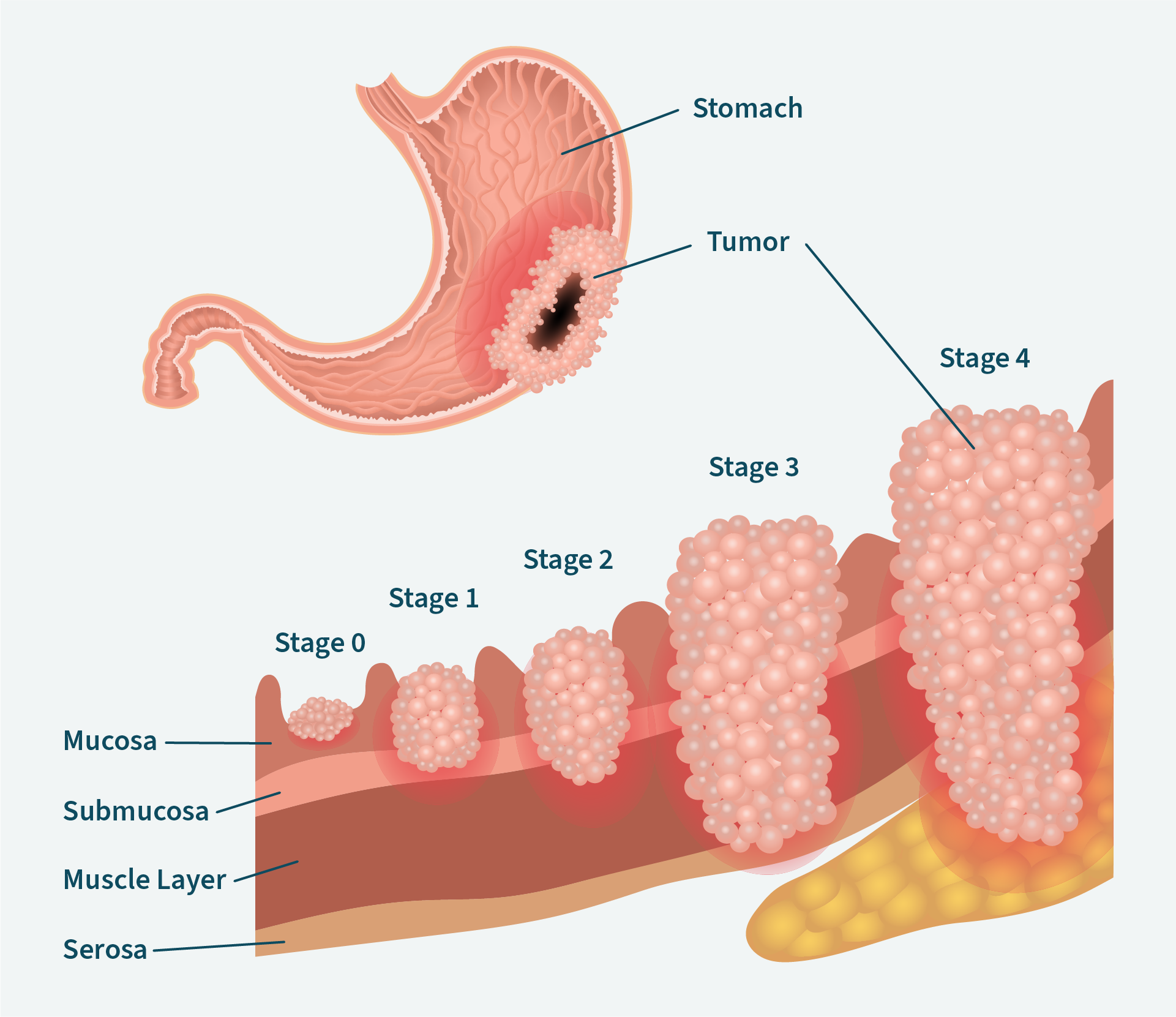 Stages Of Stomach Cancer