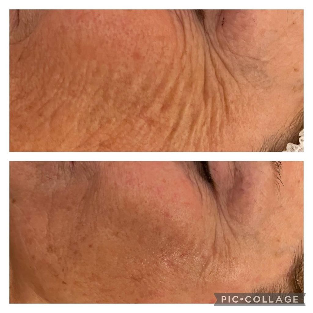 Before/after: Winback tecartherapy, or the art of enhancing natural beauty | Winback TECAR ...