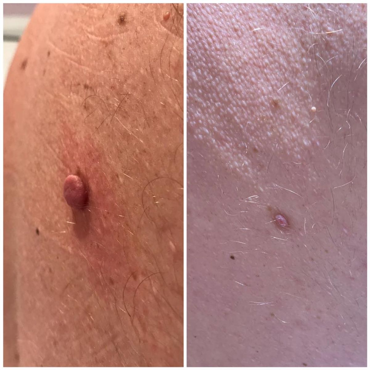 Exploring Cryotherapy for Skin Tag and Wart Removal: A Cool Solution ...