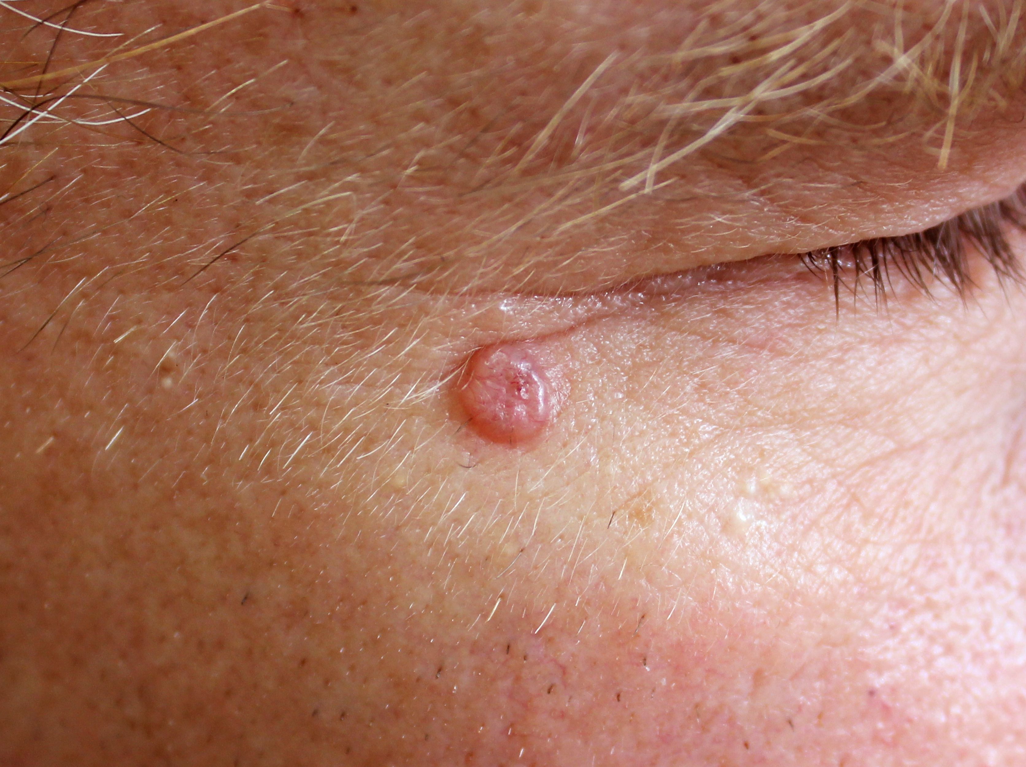 Understanding skin cancer: types, risk factors, and early detection