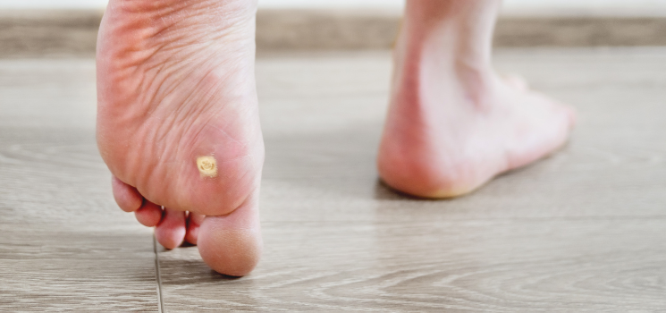 Warts 101: types, diagnosis, and treatment