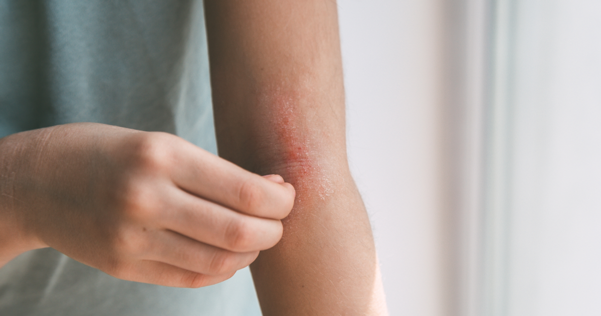 Debunking Common Myths About Atopic Eczema (Dermatitis)
