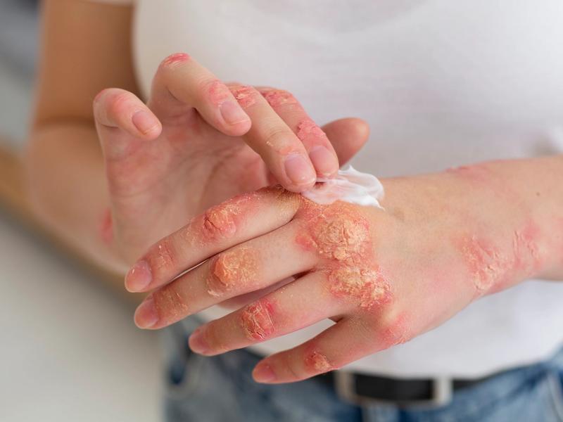 Understanding atopic eczema and newer effective treatment options