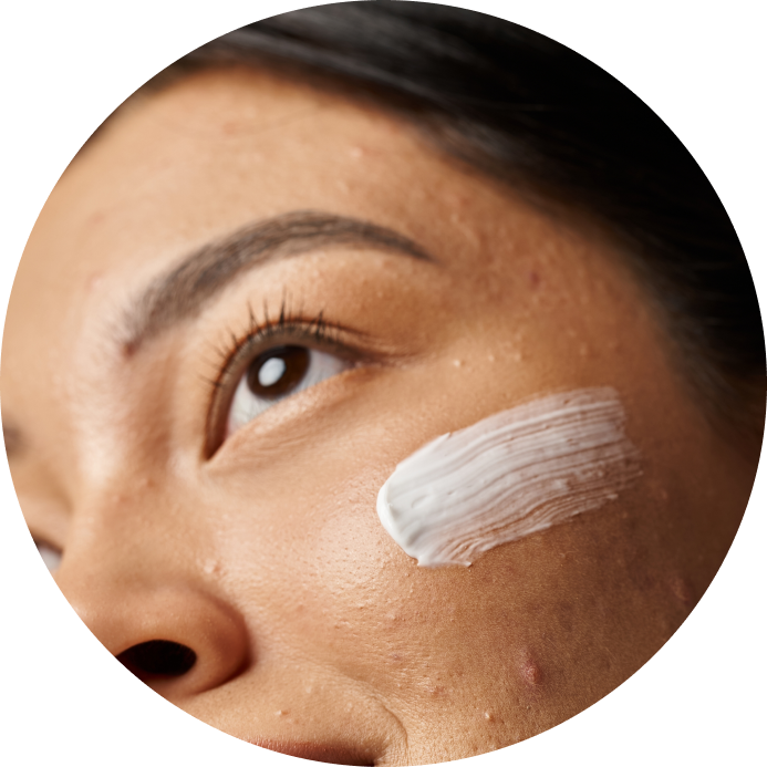 Oxy® Acne Care by Mentholatum | Clearer Skin Solutions