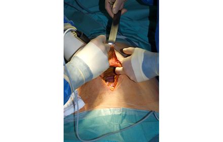 Abb.1: Die OP beginnt mit der Eröffnung der Bauchhöhle durch eine ...