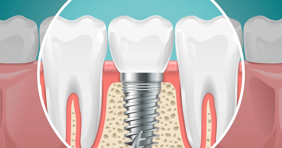 Dental Implants: The Best Permanent Tooth Replacement Option ...