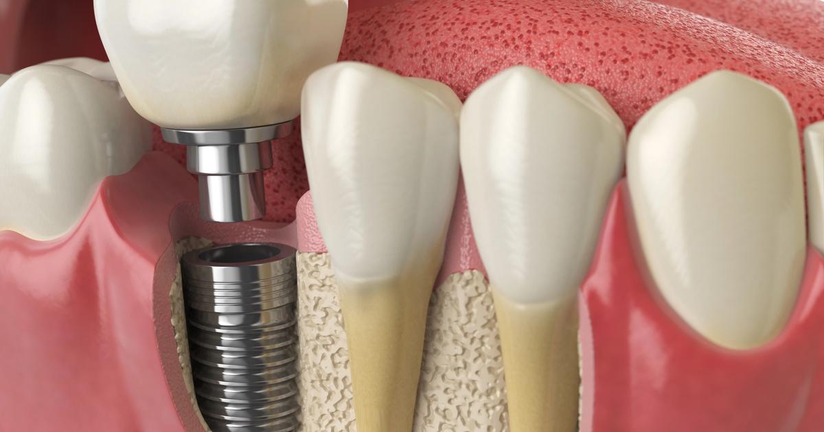 Reduce the Risk of Side Effects of Dental Implants | Affordable Dentures