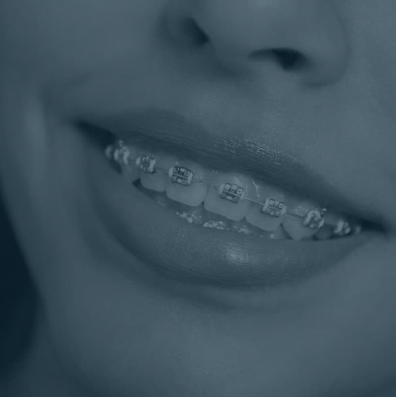 Custom braces & the latest orthodontic technology in West LAhealthy ...