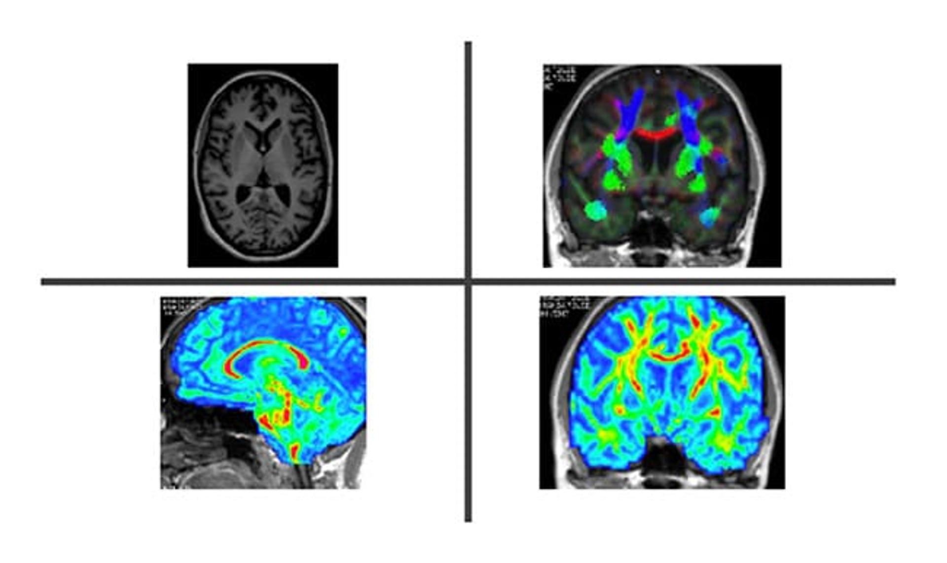 PRISM Imaging - Seizure - Insight | Brain Mapping Solutions