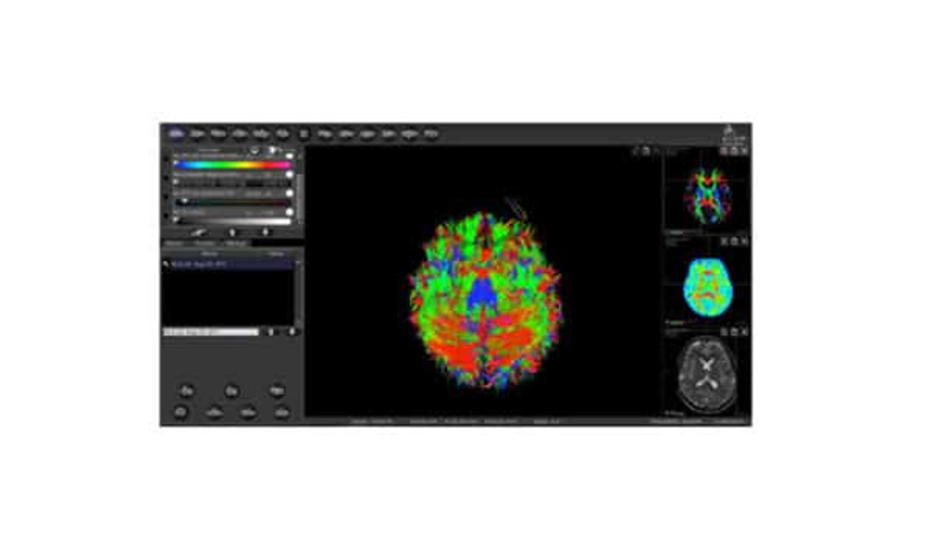 Trauma Brain Injury (TBI) Impact - Insight | Brain Mapping Solutions