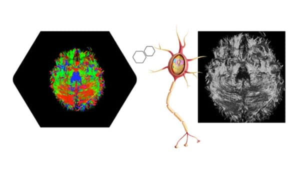 Trauma Brain Injury (TBI) Impact - Insight | Brain Mapping Solutions