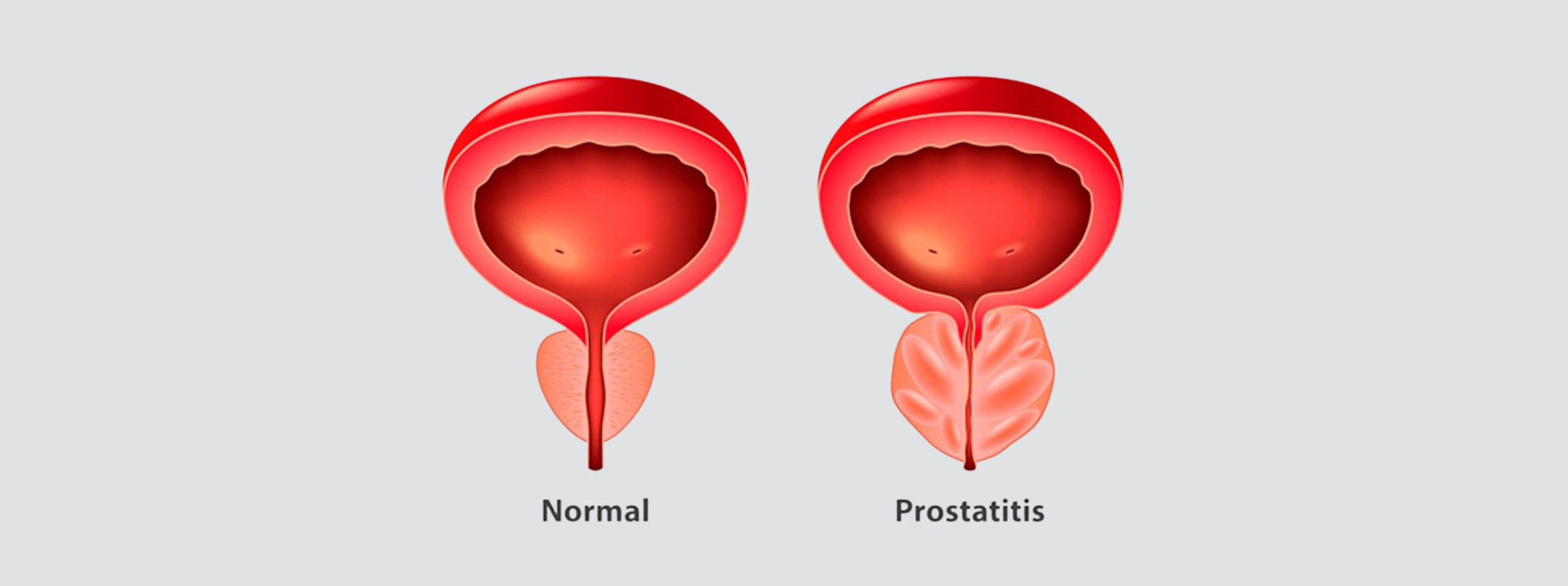 Cómo prevenir la prostatitis crónica y cuidar la próstata