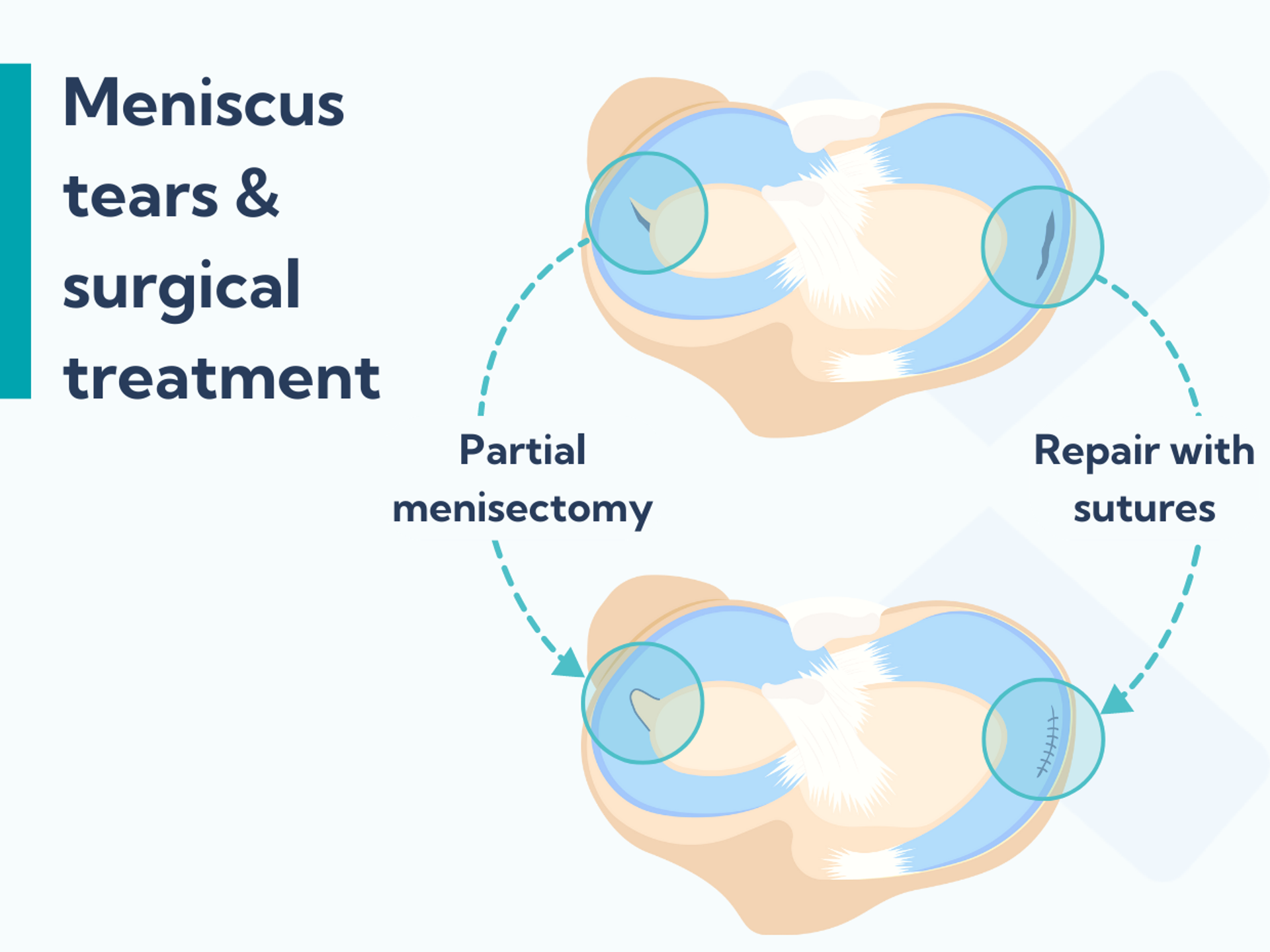 An overview of meniscus tears: Symptoms, causes, and treatment options