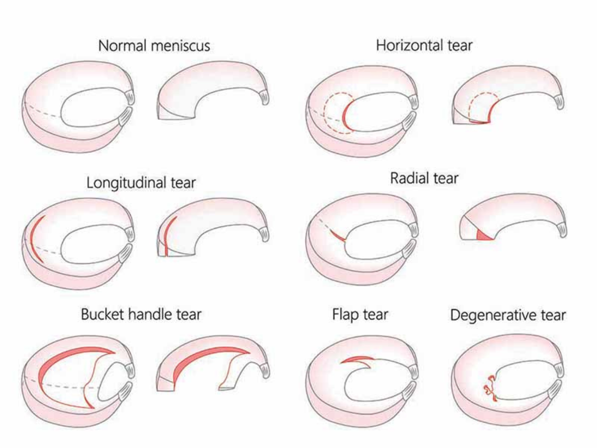 An overview of meniscus tears: Causes, symptoms, diagnosis, and ...