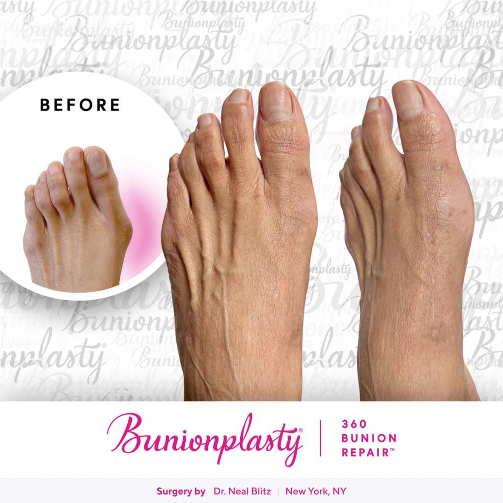 Dr. Neal Blitz | New York & California | Bunionplasty®
