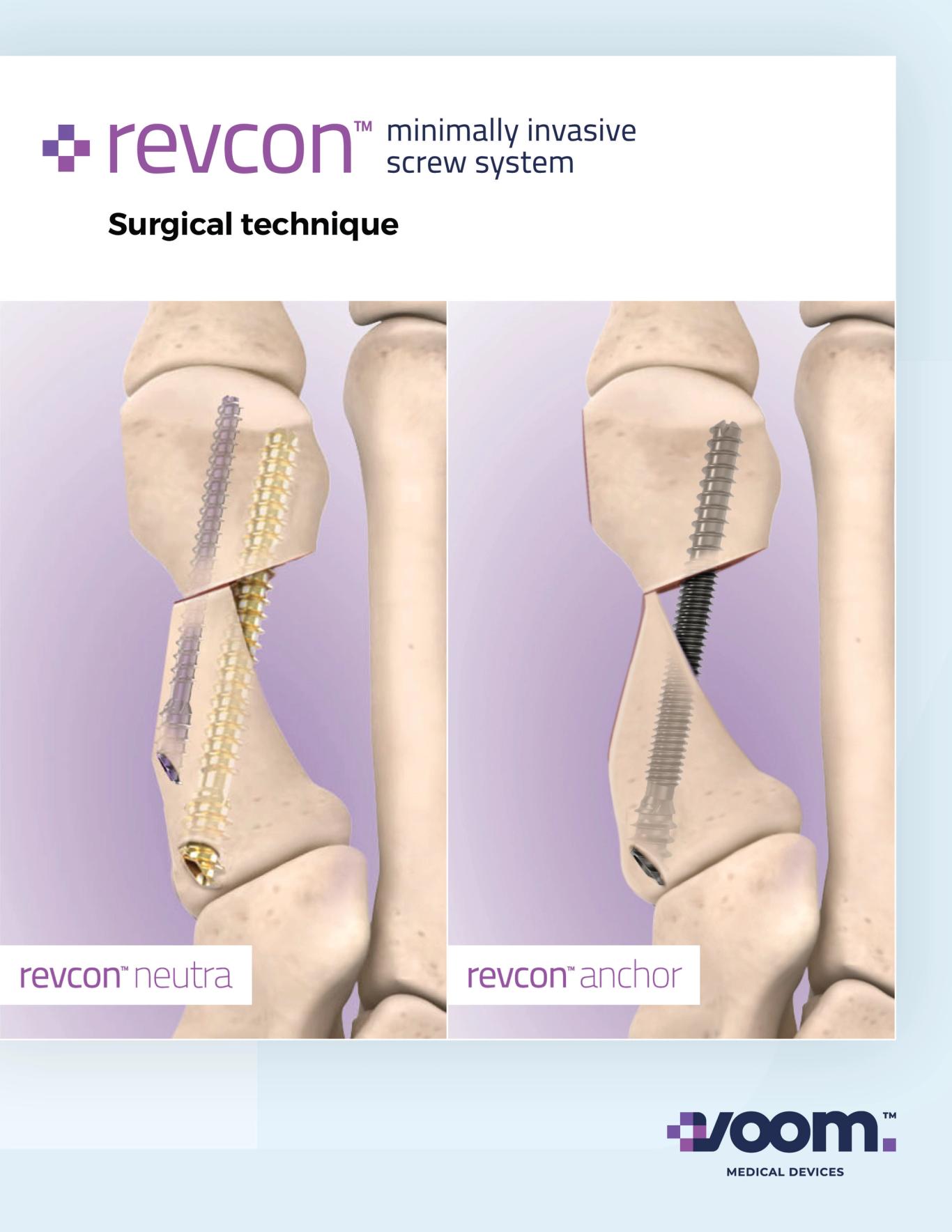 Revcon™ Screw System | Voom™ Medical Devices | Minimally Invasive ...