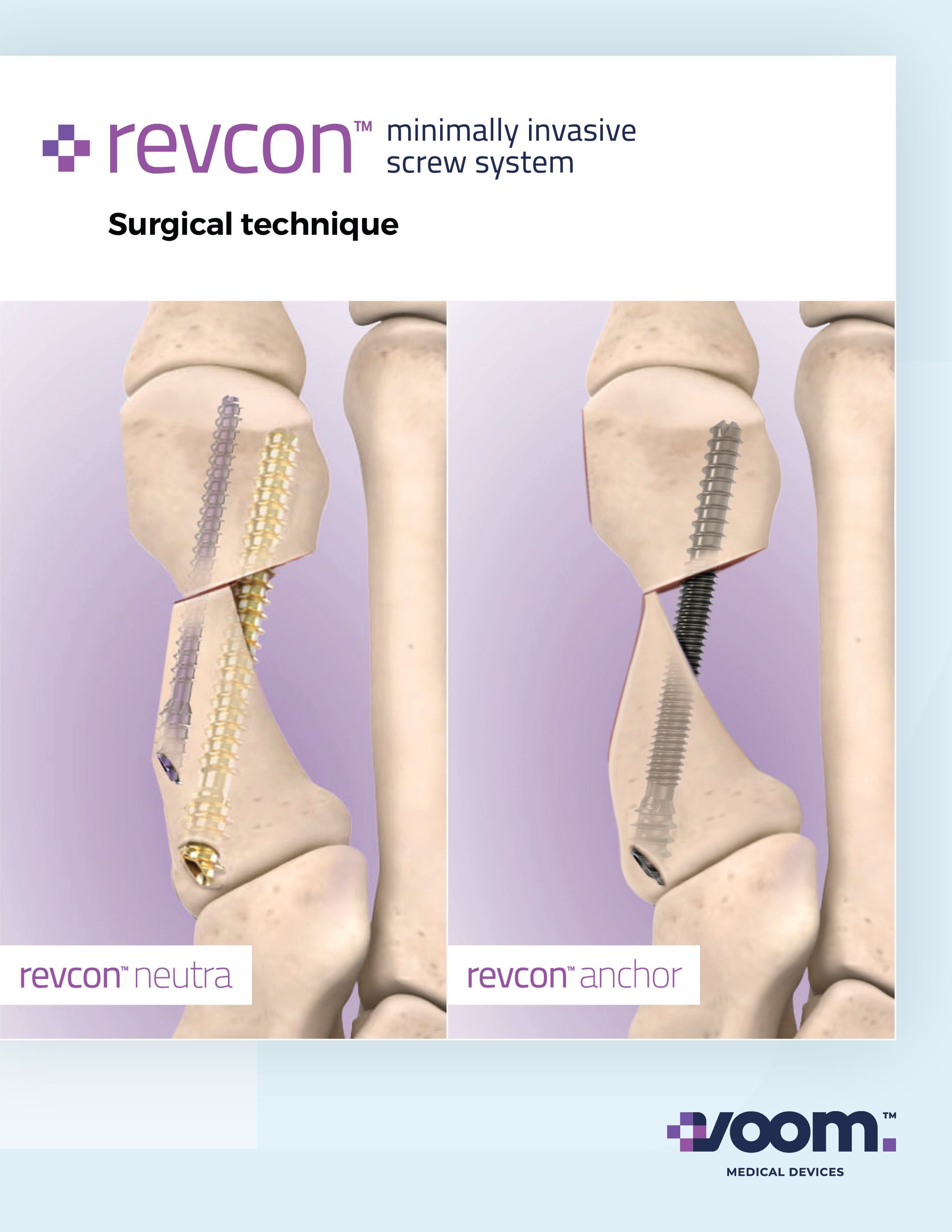 Revcon™ Screw System | Voom™ Medical Devices | Minimally Invasive Bunion Single Screw™ | Voom ...