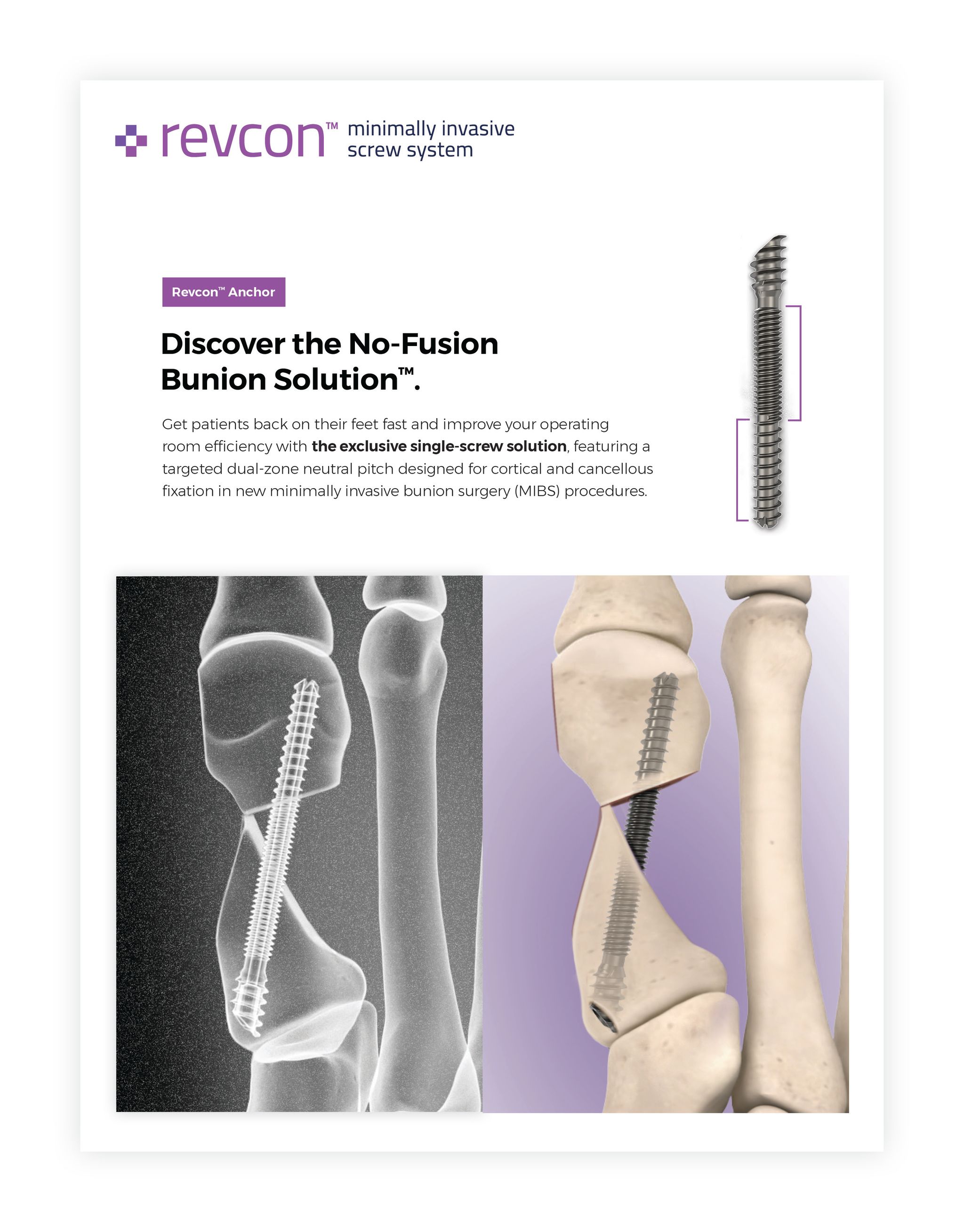 Revcon™ Screw System | Voom™ Medical Devices | Minimally Invasive ...