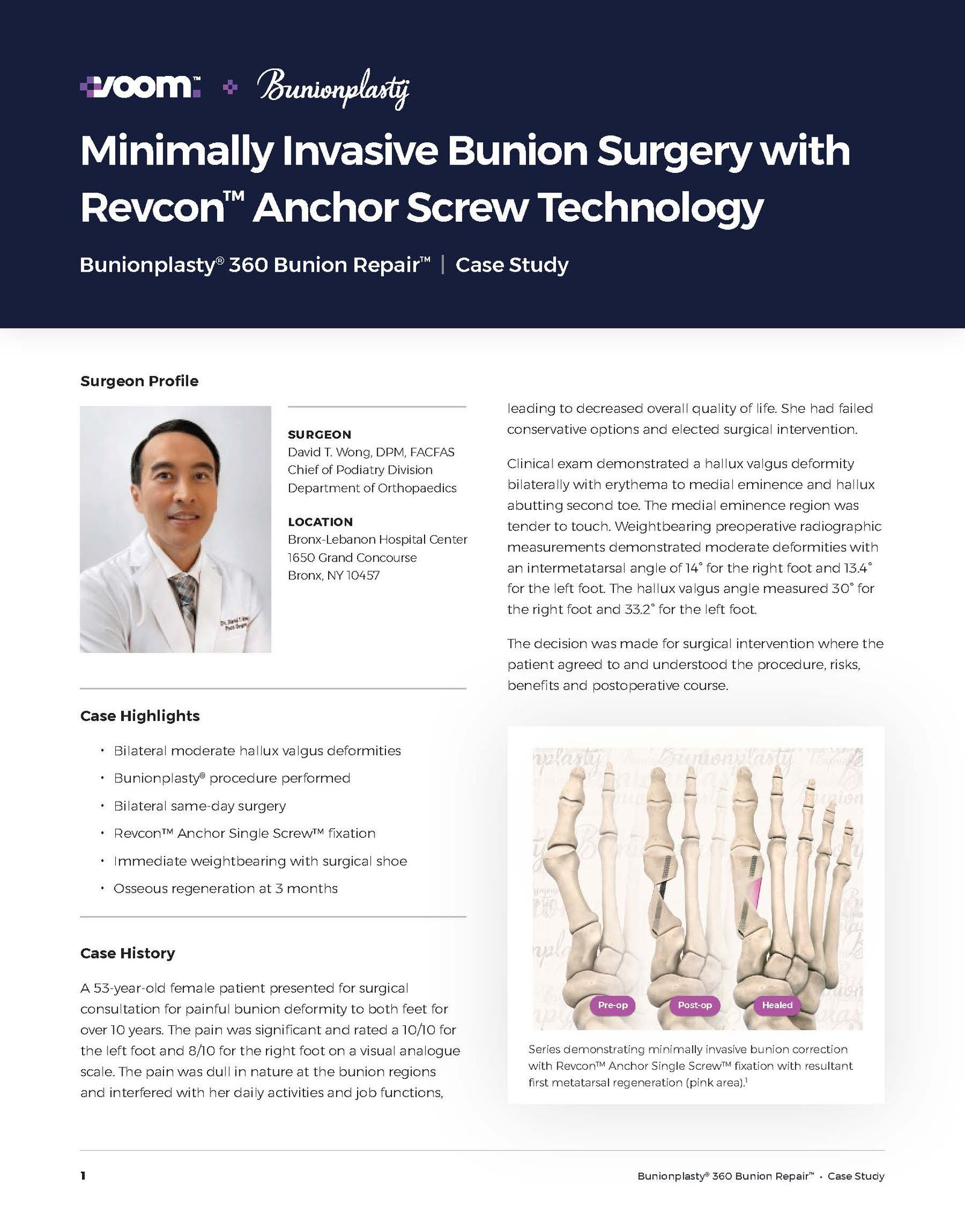 Revcon™ Screw System | Voom™ Medical Devices | Minimally Invasive ...